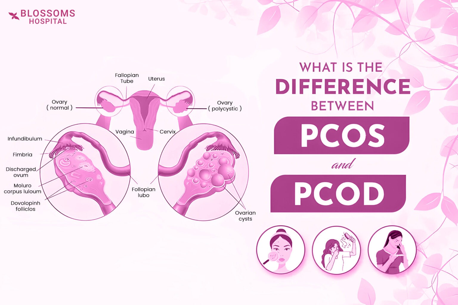 PCOD VS PCOS : Key Difference Between PCOS And PCOD
